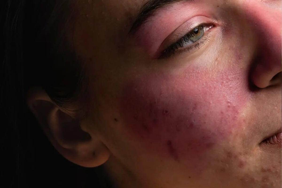 Día Mundial del Lupus: atención a una patología que se conoce como la ...