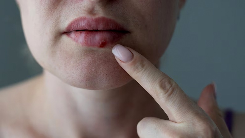 Herpes labial: qué lo activa y cuáles son las claves para controlar los ...